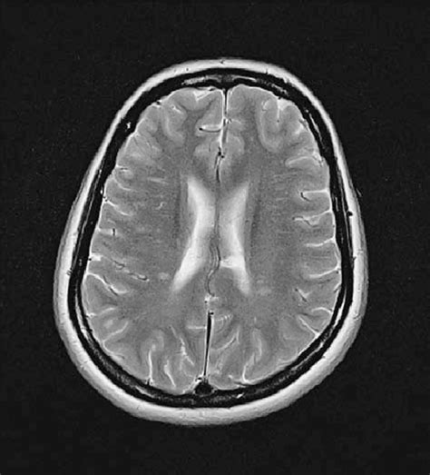 Horizontal T2 Mri Section Multiple Demyelinating Lesions Download