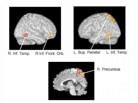 Functional Mri Activation On Finger Sequencing Contrast In Five Brain