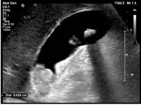 Gallbladder Quiz Flashcards Quizlet