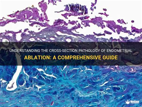 Understanding The Cross Section Pathology Of Endometrial Ablation A Comprehensive Guide Medshun