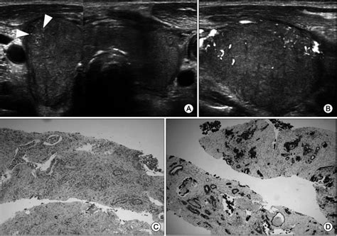 Type Ia Thyroid Metastases In A 61 Year Old Male With Lung Cancer Download Scientific Diagram