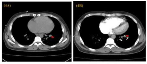 Diagnostic Value Of Pulmonary Artery Hypodense And Hyperdense Luminal