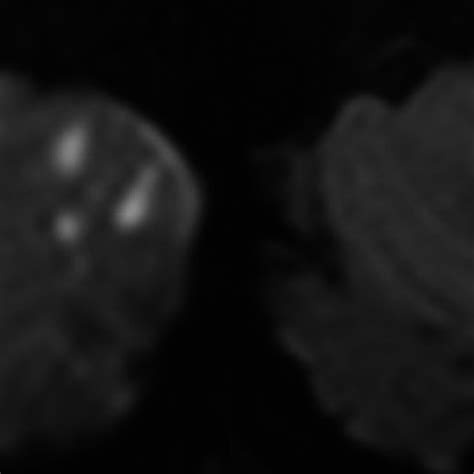 MRIDWI Showing Multiple Small Areas Of Restricted Diffusion In The Download Scientific Diagram