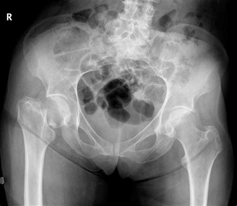 Hip Fracture X Ray