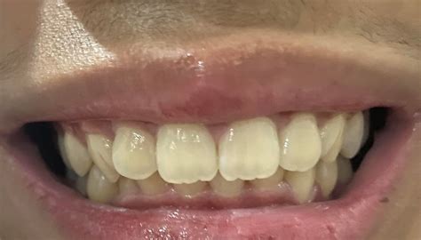Is This A Deep Bite And Do I Need Braces For It Or Can It Correct