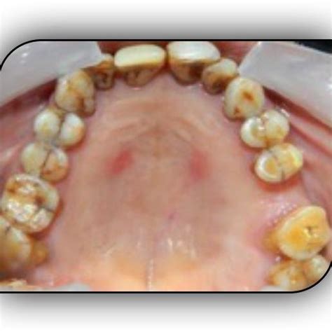 Pdf Management Of Fractured Mandibular Single Complete Denture