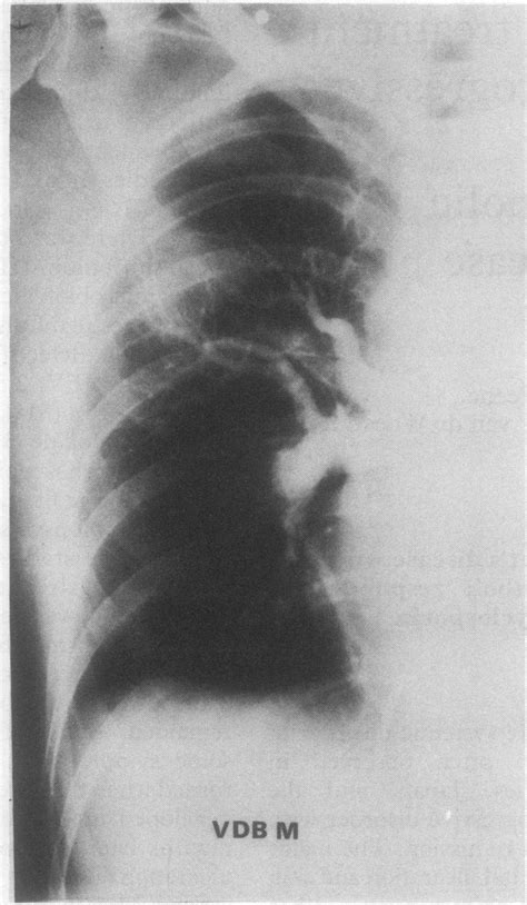 Pulmonary Artery Angiogram Showing Several Segmental Perfusion Defects Download Scientific