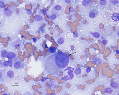 Figure 3 Macronucleolus Eclinpath