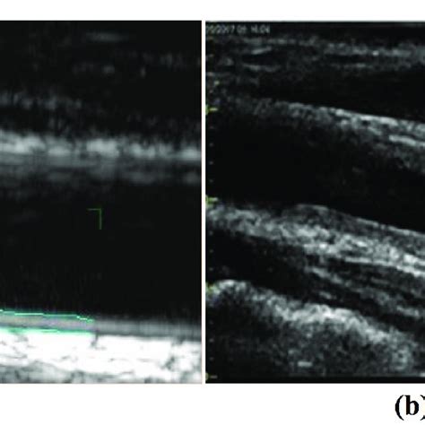 Classification Of Peritonitis Download Table
