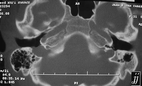 Ent Left Temporal Bone Transverse Fracture And Right Side Longitudinal And Transverse Fracture