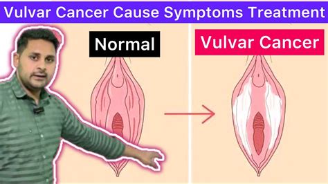 Vulvar Cancer Cause Symptoms Diagnostic Evaluation Treatment Vulvar Cancer What Is Vulvar