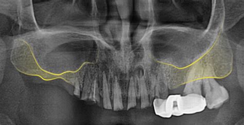 뼈이식 임플란트