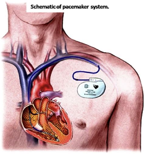 Diagram Illustrating The Autonomous Pacemaker System [62] Download Scientific Diagram