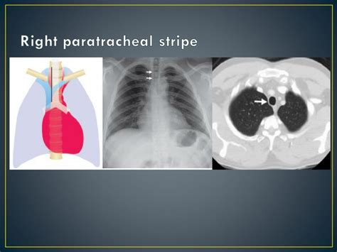 Ppt Imaging Anatomy Of The Mediastinum Powerpoint Presentation Free