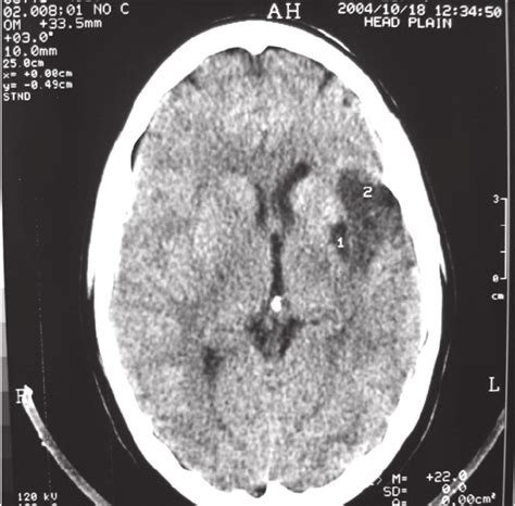 Brain Ct Scan Of Patient 1 Showing Infarcts In Left Opercular And