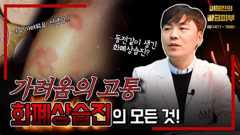 화폐상 습진 건선과 비슷해보이기도 하지만 다른 질환입니다 연세에이앤비 피부과 이해진원장 Youtube