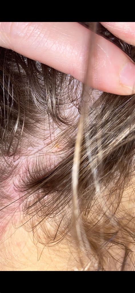 Scalp Folliculitis R Folliculitis