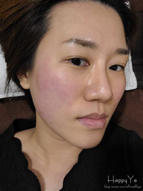 강남 피부과 청담 튠페이스 리프팅 후기 네이버 블로그