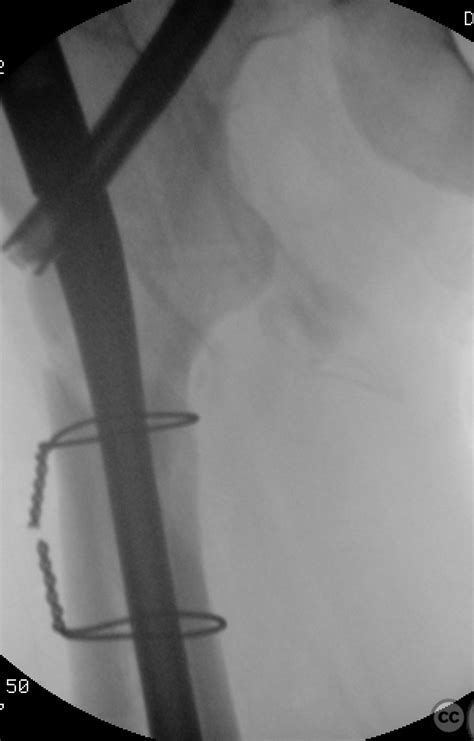 Closed Segmental Comminuted Femoral Fracture