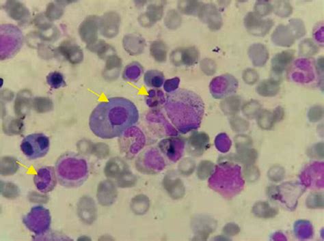 Csf3r Gln776x And Asxl1 Mutations In Multiple Myeloma Associated With Chronic Neutrophilic