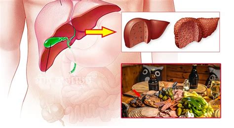 ចំណេះដឹងសុខភាព កត្ដាទាំងនេះធ្វើឱ្យថ្លើមរបស់អ្នកឆាប់ខូច