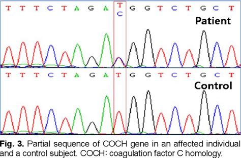 Figure 1 From A Case Of Cochlear Implantation In A Patient With