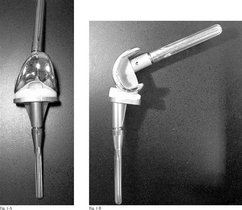 Figure 1 From Revision Total Knee Arthroplasty With Use Of A