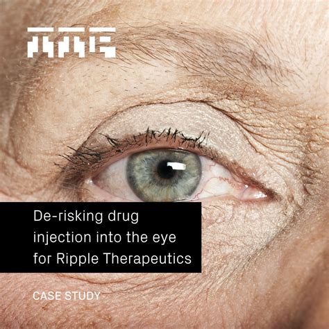 Ttp Plc On Linkedin Intraocular Injections Have Witnessed A Staggering Surge In Volume So