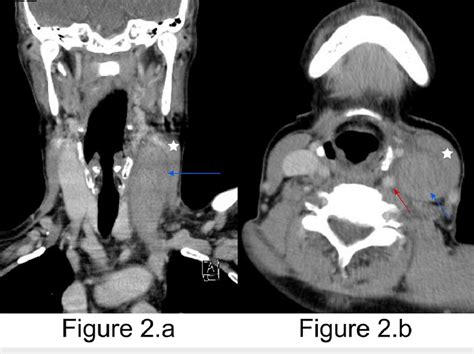 Neck Ct Anatomy Normal Anatomy Of The Neck With Ct And Mr Imaging