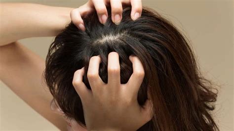 Acne No Couro Cabeludo Especialista Explica Como Tratar