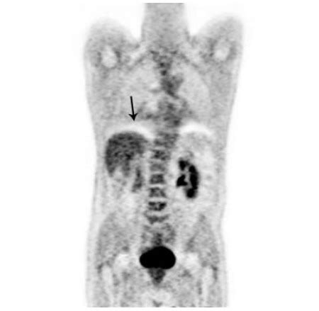 Hybrid With CT Flashcards Quizlet