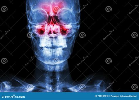 Sinusitis Stock Image Image Of Head Ethmoidal Anatomy 79229329