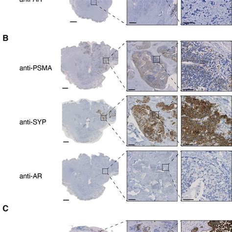 Persistent Psma Expression In Residual Tumor With Neuroendocrine Download Scientific Diagram