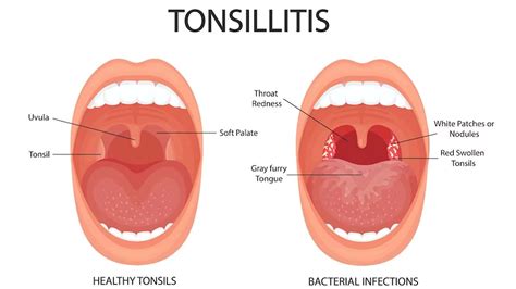 Can Tonsillitis Cause Ear Pain