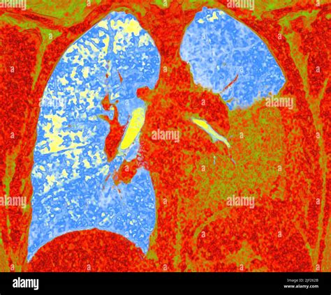 Coloured Computed Tomography Ct Scan Of The Chest Of A Patient With