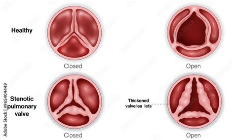 Pulmonary Valve Stenosis Open And Closed State Comparison With Normal Pulmonary Valve Function