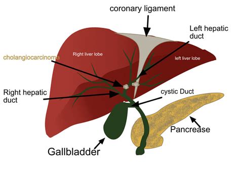 What Is Cholangiocarcinoma And How Its Diagnosed Omar Rashid