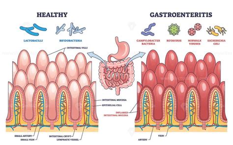Crohns Disease Symptoms From Inflammatory Bowel Illness Outline Diagram