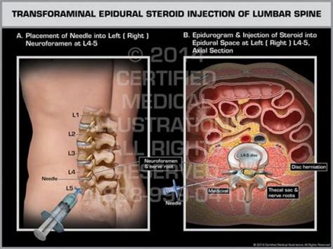Facet Joint Nerve Block Injection Mapasgmaes
