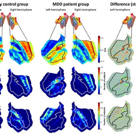 Spatial Distribution Of Currents Normal To The Cortical Surface