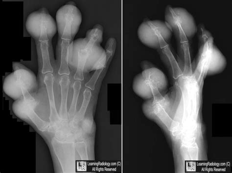 Learningradiology Gout Hand Gouty Arthritis Finger Xray X Ray