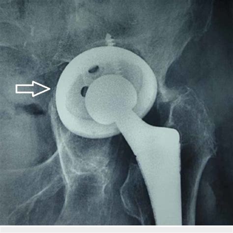 Asymptomatic Aseptic Loosening Of The Acetabular Component In An Download Scientific Diagram