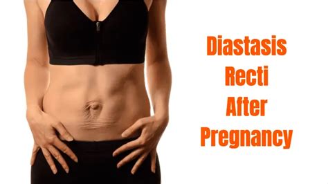 Diastasis Recti After Pregnancy Onward Physical Therapy