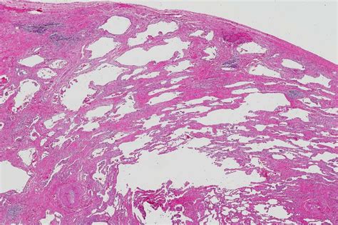 50 Facts About Idiopathic Diffuse Interstitial Fibrosis 50 Facts About Idiopathic Diffuse Interstitial Fibrosis
