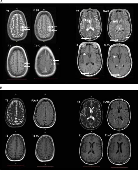 Brain Mri T2 Weighted Sequence Hyperintense Lesions O