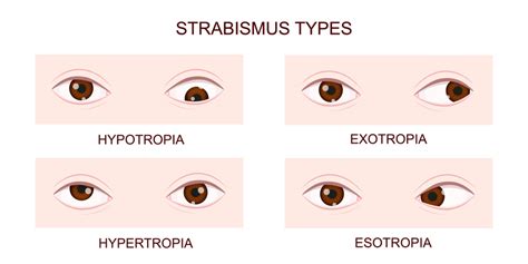 Strabismus Eye Center South
