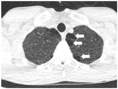 Spontaneous Pneumothorax
