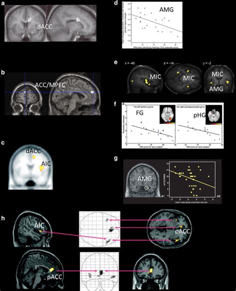 Reduced Brain Response In Alexithymia Relative To External Visual Download Scientific Diagram