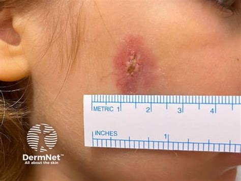 Idiopathic Facial Aseptic Granuloma — Dermnet
