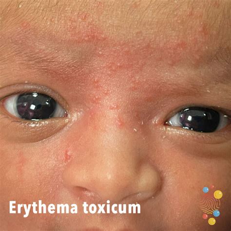 Neonatal Dermatology Dont Forget The Bubbles Neonatal Dermatology Dont Forget The Bubbles